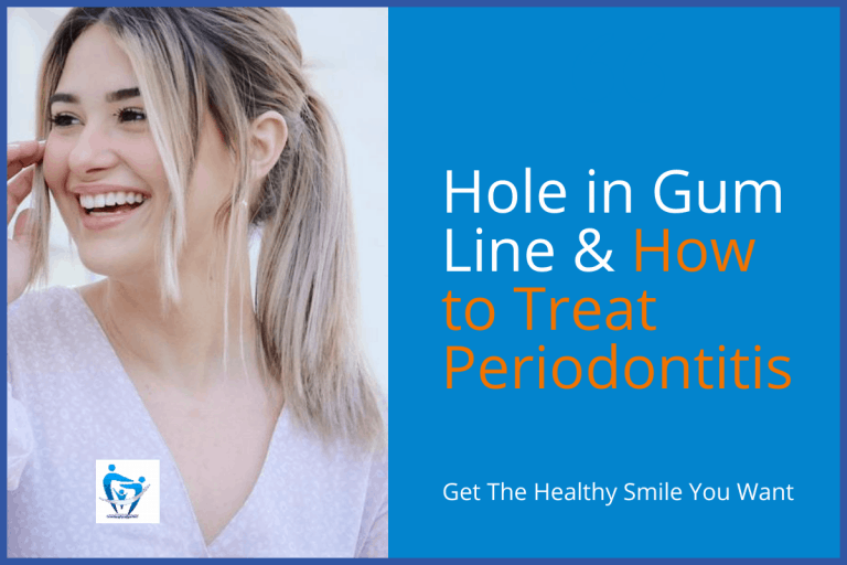 Hole in Gum Line & How to Treat Periodontitis