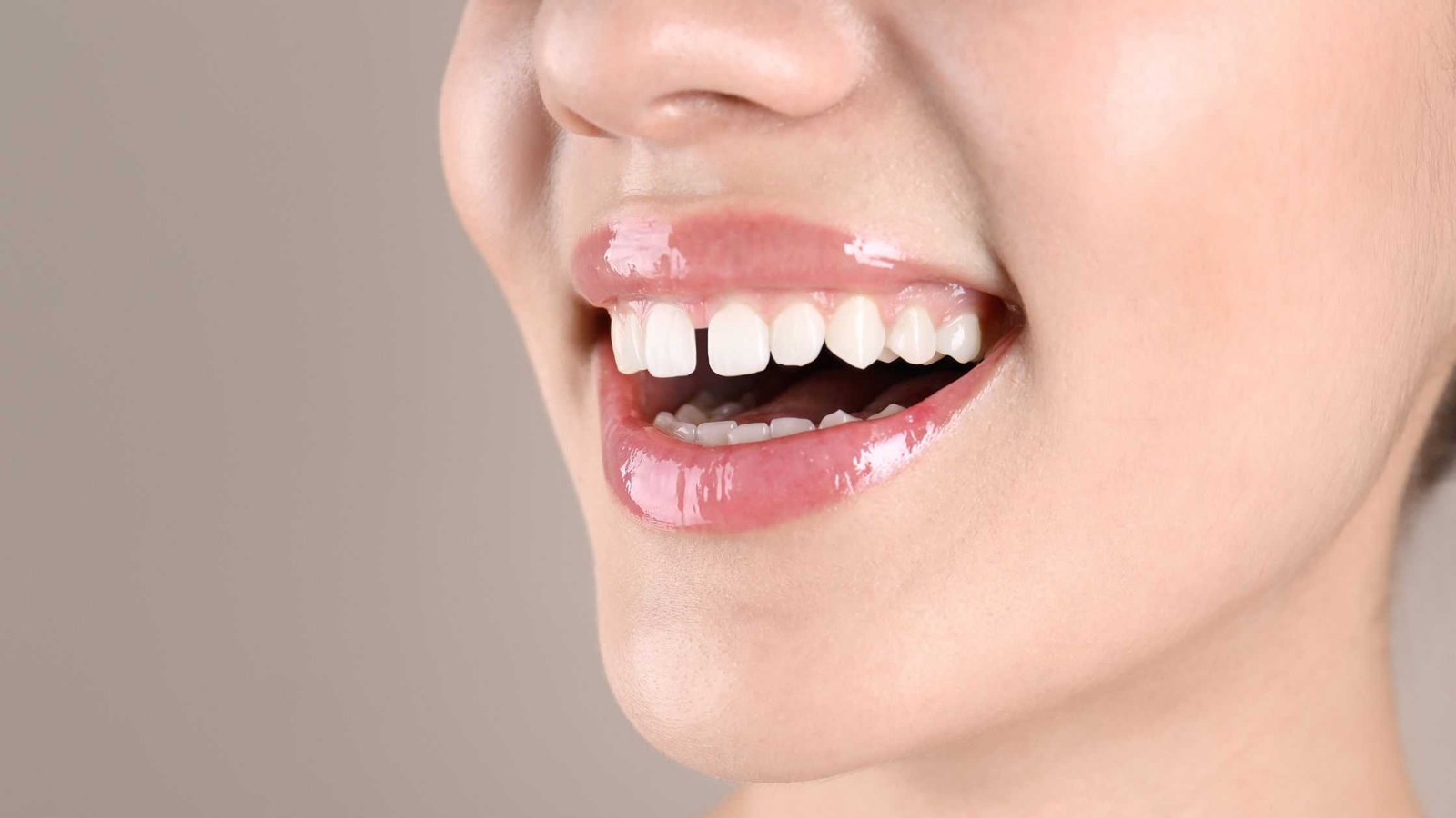 Dental Diastema: Definition, Types, Causes and Solutions