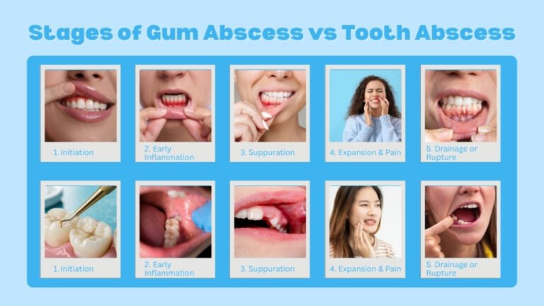 Gum Abscess Stages vs. Tooth Abscess Stages: What’s the Difference?
